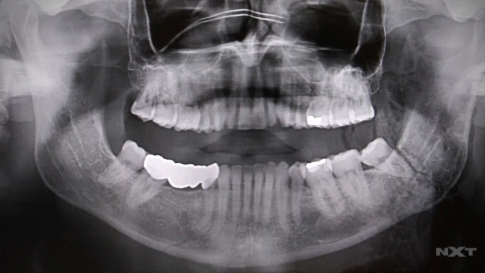 Finn Balor Has a Broken Jaw – TPWW